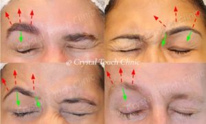 What is Synkinesis? • Crystal Touch Bell's Palsy Clinic